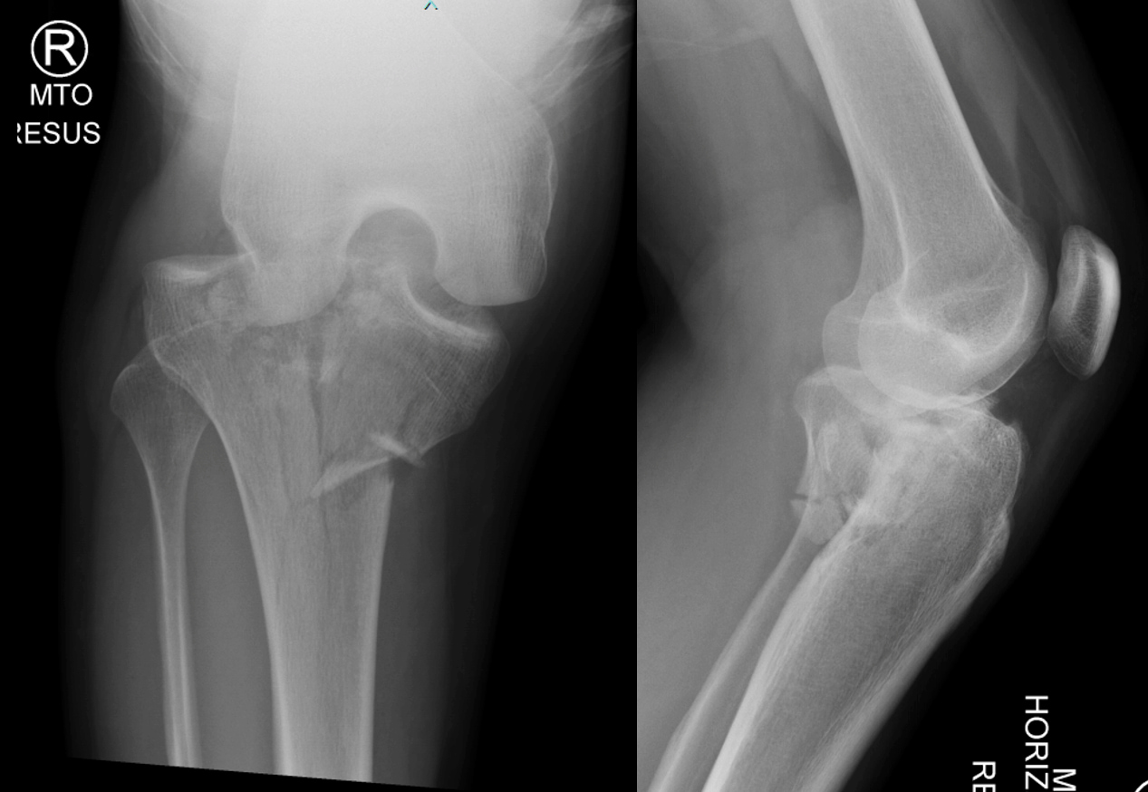 Fractures - Dr. Anton Lambers – Orthopaedic Surgeon in Bright
