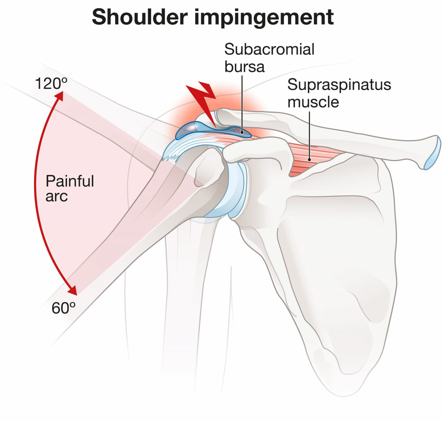 Shoulder impingement and bursitis - Dr. Anton Lambers – Orthopaedic ...