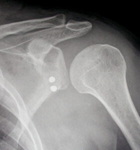 Latarjet procedure - Dr. Anton Lambers – Orthopaedic Surgeon in Bright