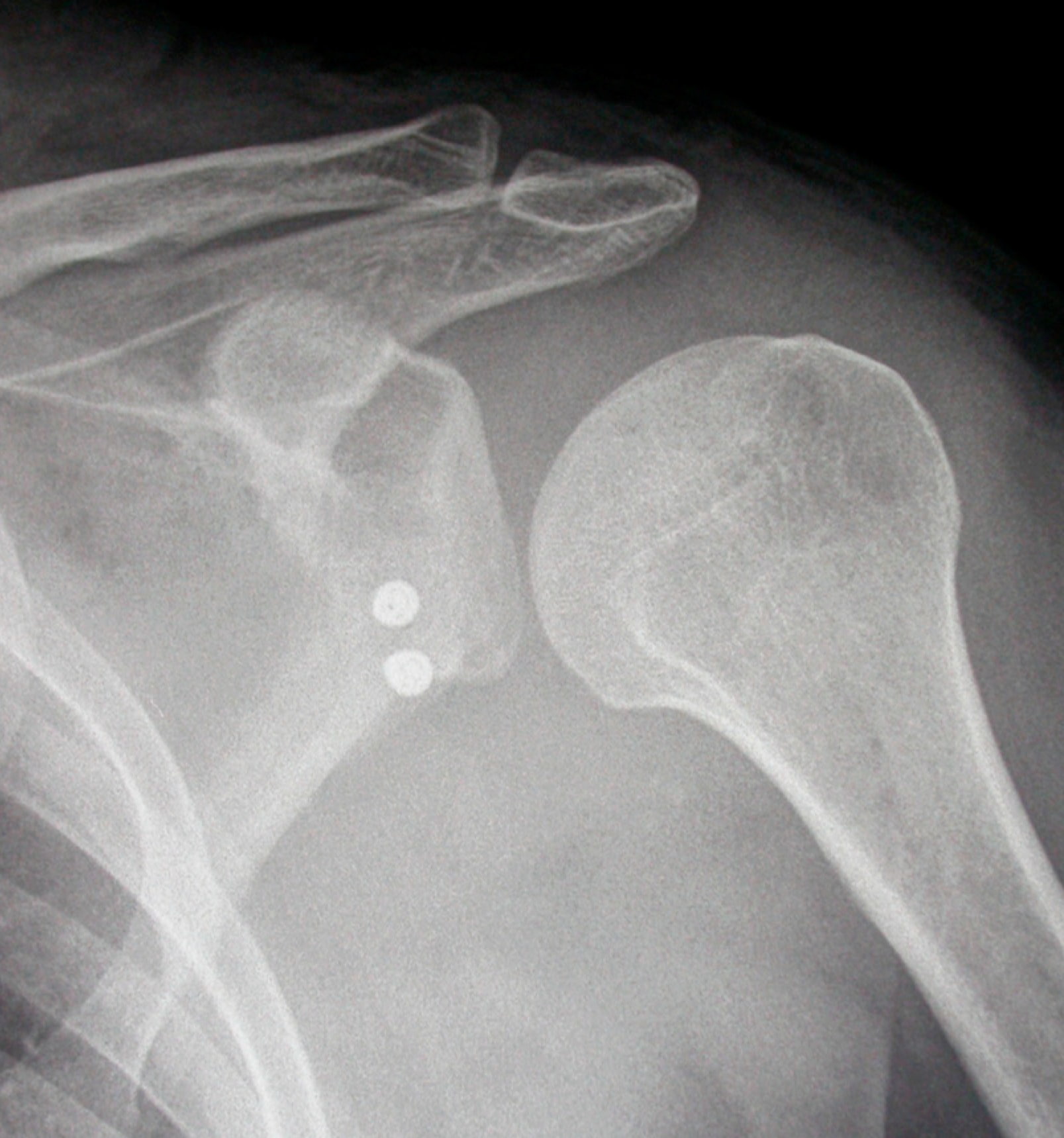 Latarjet procedure - Dr. Anton Lambers – Orthopaedic Surgeon in Bright